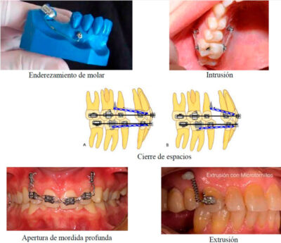 Tratamiento de Ortodoncia con uso de Microimplantes » Maxilofacial e ...