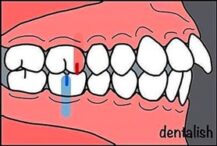 Clasificación de Maloclusiones » Maxilofacial e Implantes Dr. Molina Moguel