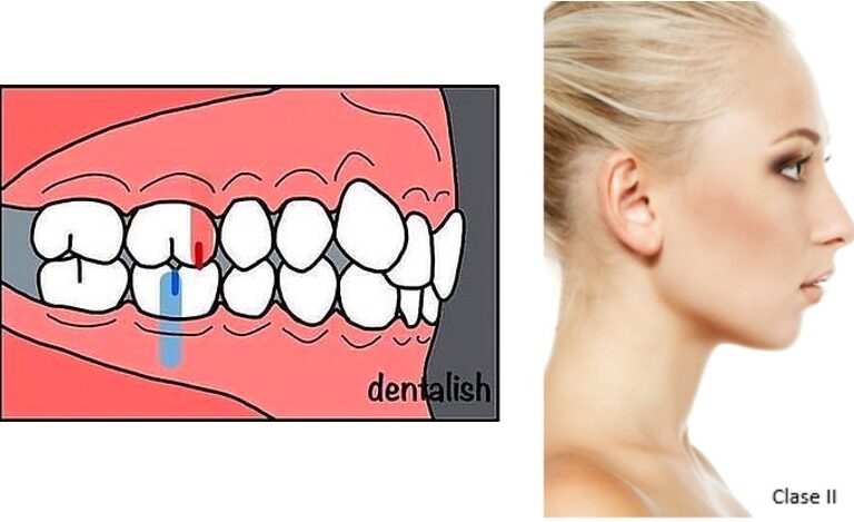 Clasificación de Maloclusiones » Maxilofacial e Implantes Dr. Molina Moguel