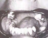 Anquilosis de Articulación Temporomandibular » Maxilofacial e Implantes ...